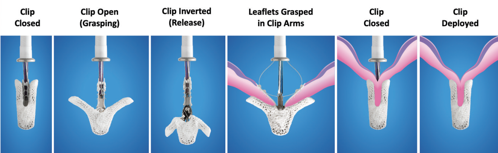 Reparación de válvula mitral transcatéter (Mitraclip) – Dr. Juan Carlos Ceballos