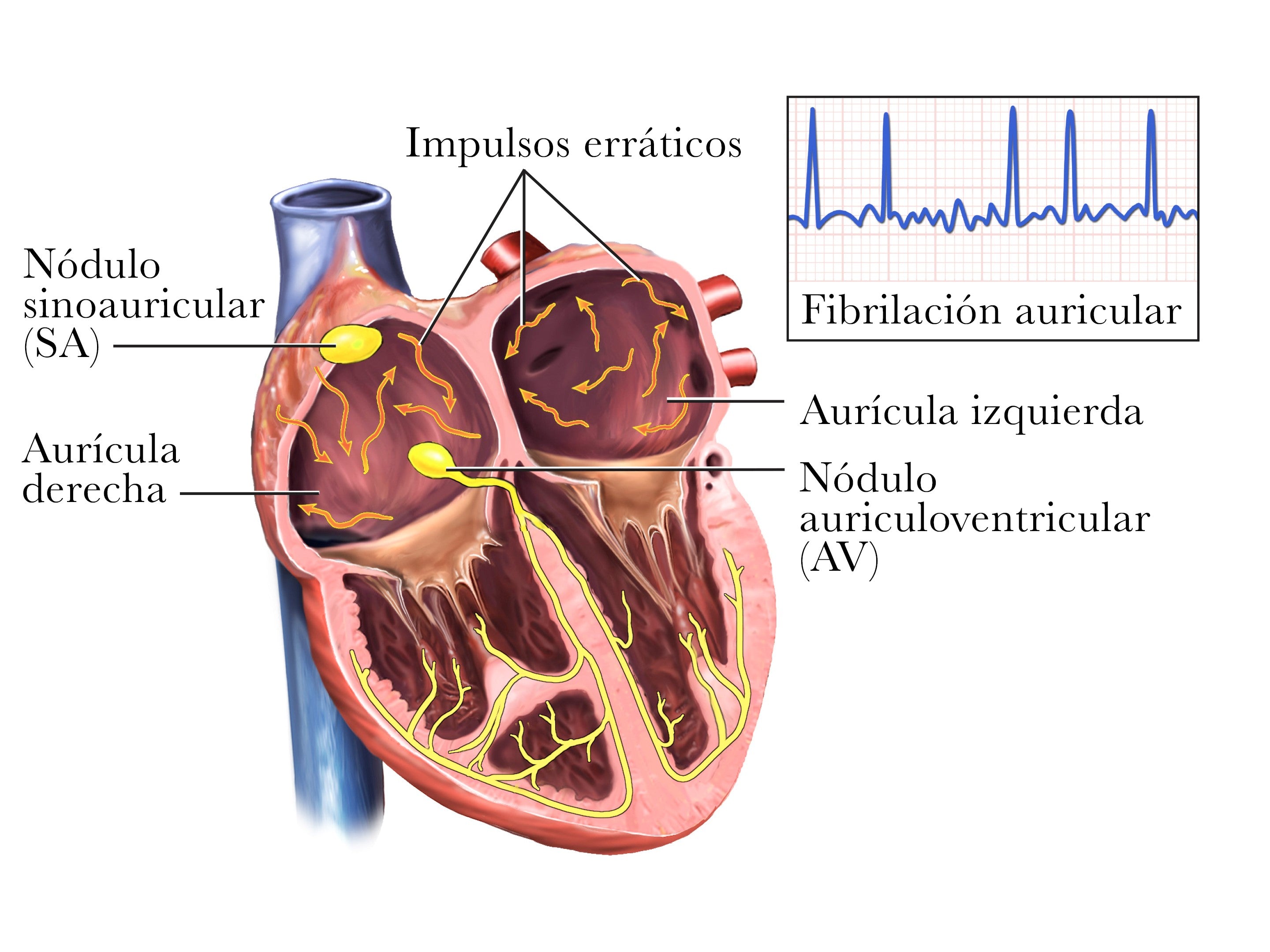 Fibrilación Auricular – Dr. Juan Carlos Ceballos